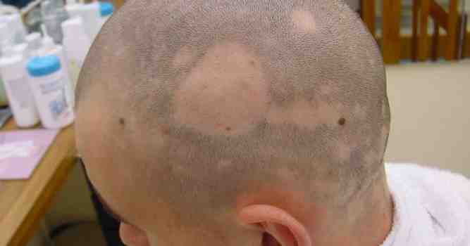 Les traitements des alopécies - Cheveurama